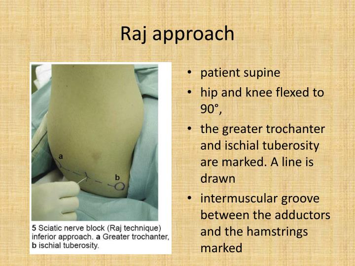 PPT - Sciatic nerve block PowerPoint Presentation - ID:2074459