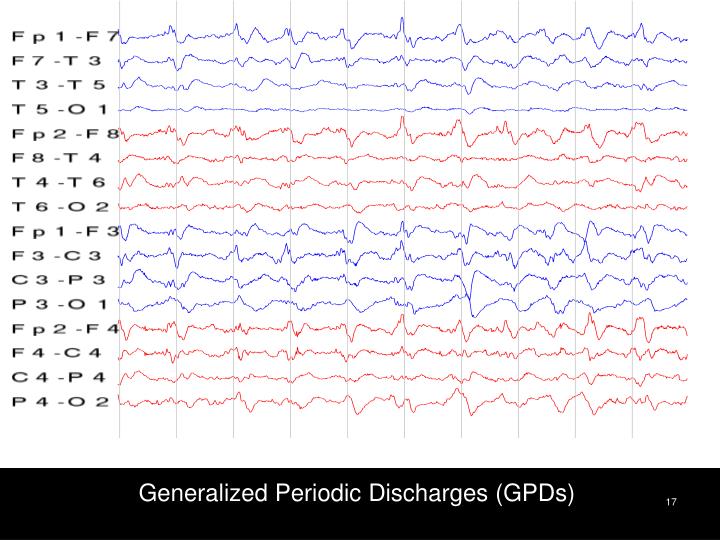 PPT - American Clinical Neurophysiology Society’s Standardized Critical ...