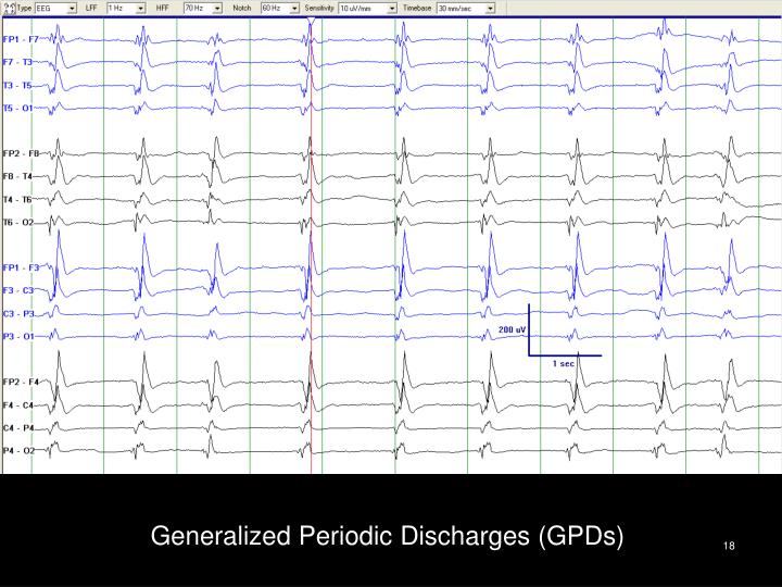 PPT - American Clinical Neurophysiology Society’s Standardized Critical ...