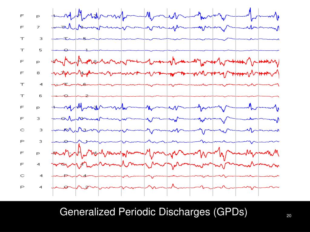 PPT - American Clinical Neurophysiology Society’s Standardized Critical ...