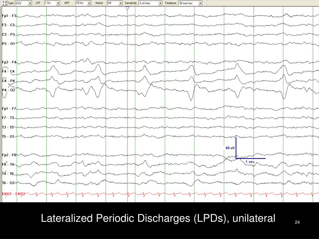 PPT - American Clinical Neurophysiology Society’s Standardized Critical ...