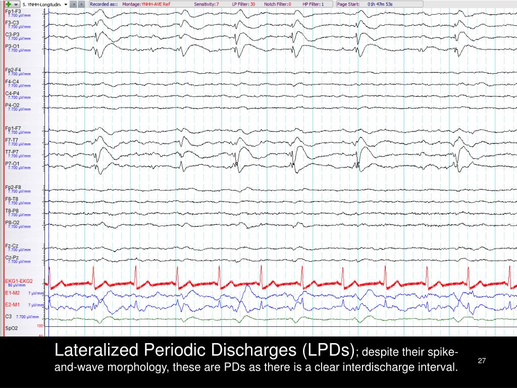 PPT - American Clinical Neurophysiology Society’s Standardized Critical ...