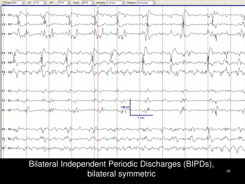 PPT - American Clinical Neurophysiology Society’s Standardized Critical ...
