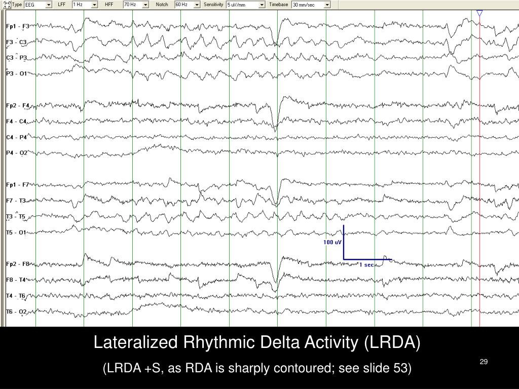 PPT - American Clinical Neurophysiology Society’s Standardized Critical ...