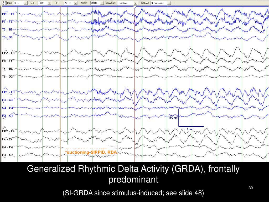 PPT - American Clinical Neurophysiology Society’s Standardized Critical ...