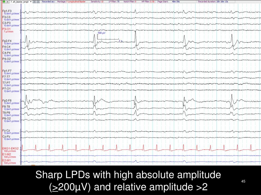 PPT - American Clinical Neurophysiology Society’s Standardized Critical ...