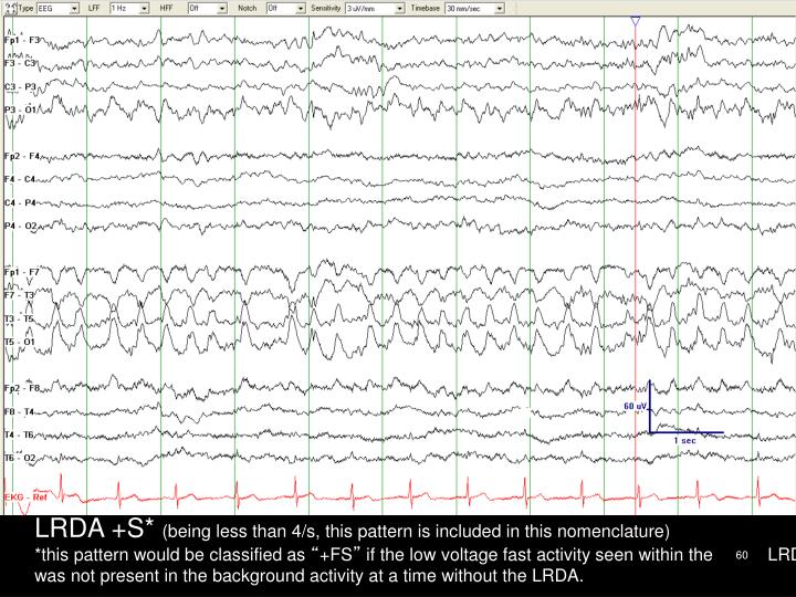 PPT - American Clinical Neurophysiology Society’s Standardized Critical ...