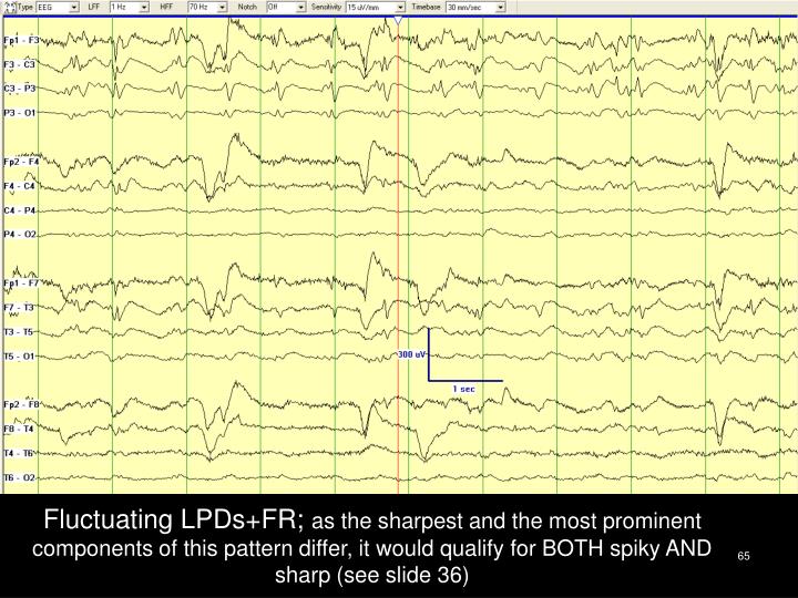 PPT - American Clinical Neurophysiology Society’s Standardized Critical ...