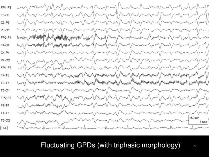 PPT - American Clinical Neurophysiology Society’s Standardized Critical ...