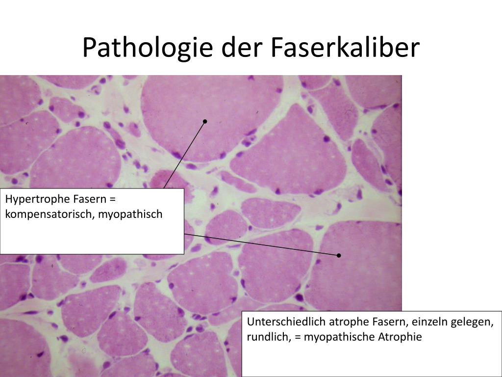 PPT - Muskeldystrophien beim Erwachsenen PowerPoint Presentation, free ...