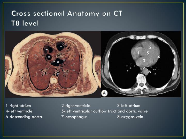 PPT - Imaging Anatomy of the Mediastinum PowerPoint Presentation - ID ...