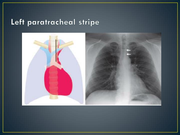 PPT - Imaging Anatomy of the Mediastinum PowerPoint Presentation - ID ...