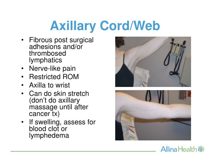 PPT - Breast Cancer Rehabilitation PowerPoint Presentation - ID:2077045