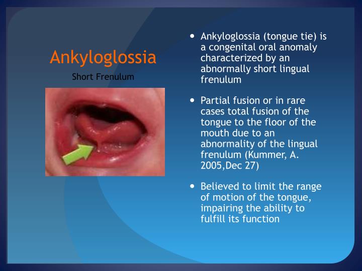 PPT - ANKYLOGLOSSIA PowerPoint Presentation - ID:2078965