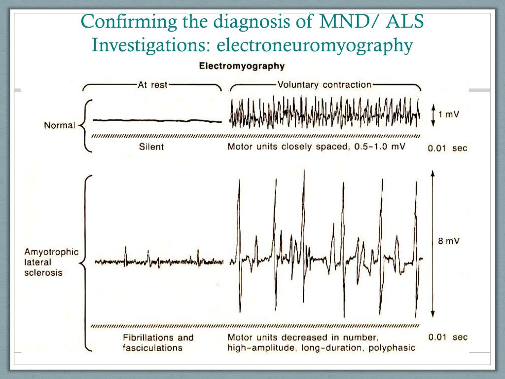 PPT - Diagnosis of motor neuron disease PowerPoint Presentation, free ...