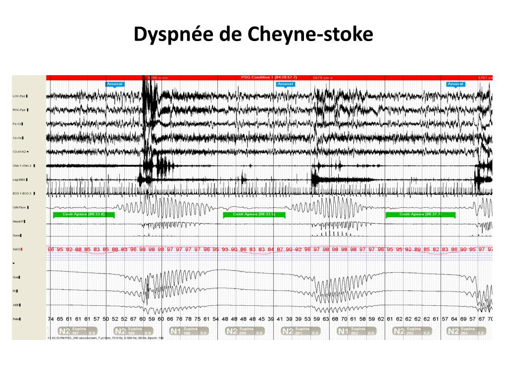 PPT - Syndrome d’apnées du sommeil chez le sujet âgé PowerPoint ...