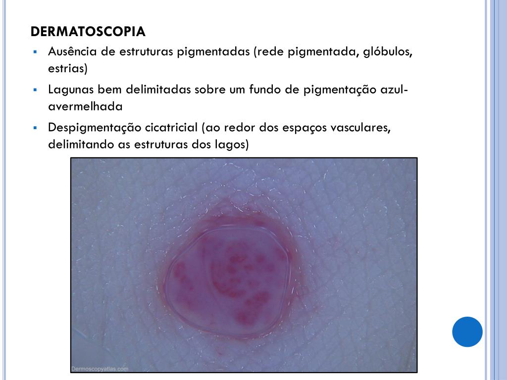 PPT - DERMATOSCOPIA DE LESÕES pigmentadas NÃO MELANOCITICAS PowerPoint ...