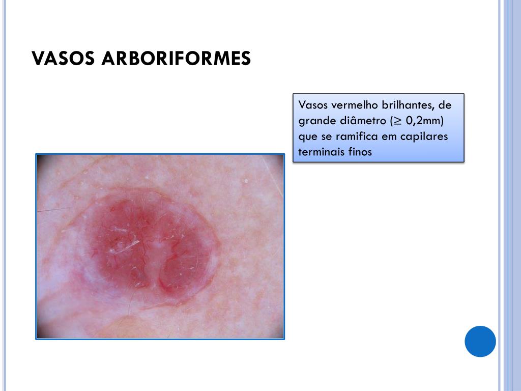 PPT - DERMATOSCOPIA DE LESÕES pigmentadas NÃO MELANOCITICAS PowerPoint ...