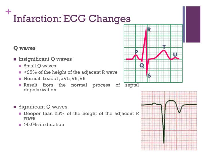 PPT - ECG Changes in Myocardial Infarction PowerPoint Presentation - ID ...
