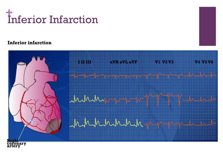 PPT - ECG Changes in Myocardial Infarction PowerPoint Presentation - ID ...