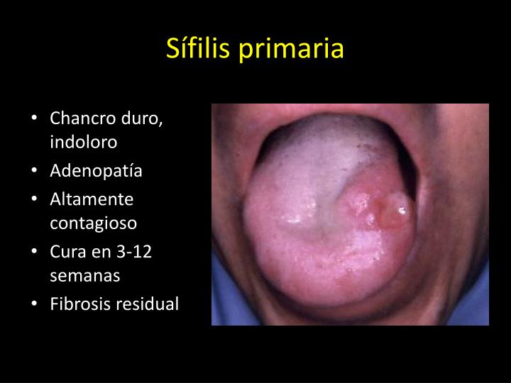 PPT - DIAGNÓSTICO SEROLÓGICO DE SÍFILIS PowerPoint Presentation - ID ...