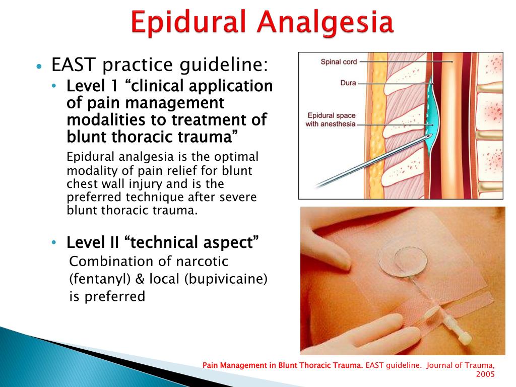 PPT - Novel Treatments of Rib Fractures: Hype or Future? PowerPoint ...