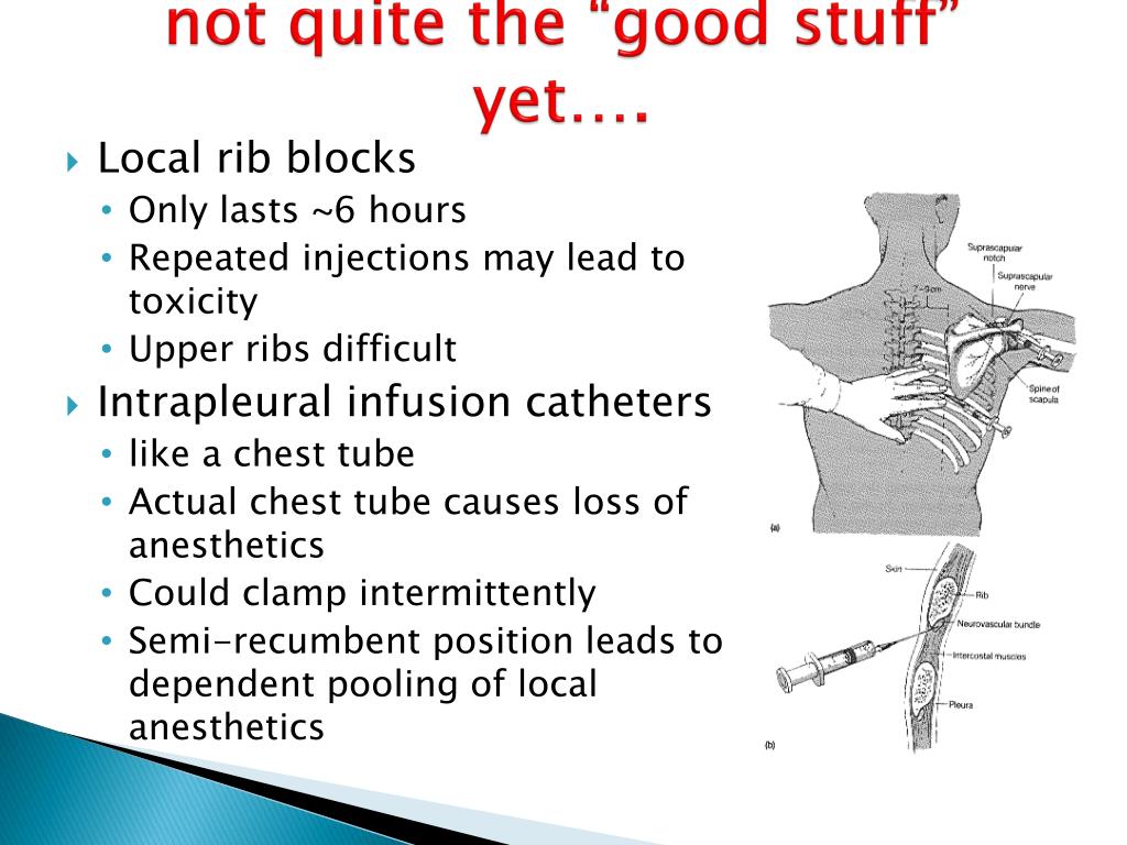 PPT - Novel Treatments of Rib Fractures: Hype or Future? PowerPoint ...