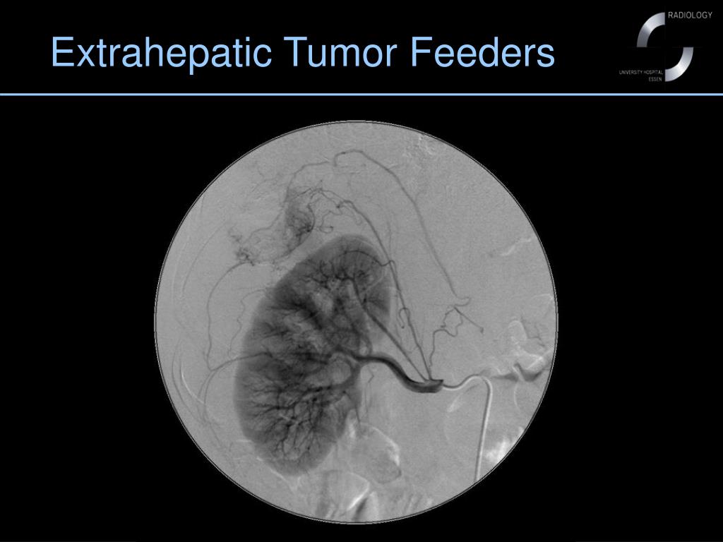 PPT - Liver Cancer Management with Y90 Glass Microspheres – TheraSphere ...