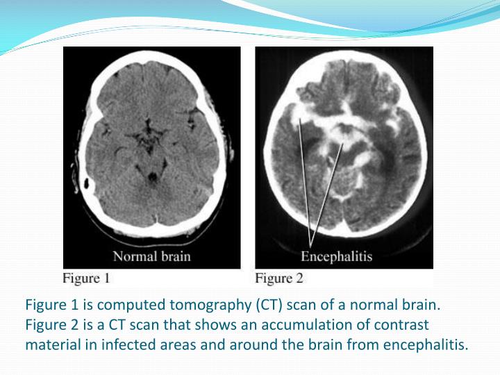 PPT - Encephalitis PowerPoint Presentation - ID:2096282