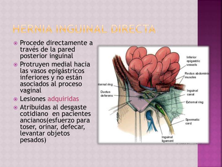 PPT - Hernia inguinal PowerPoint Presentation - ID:2097299