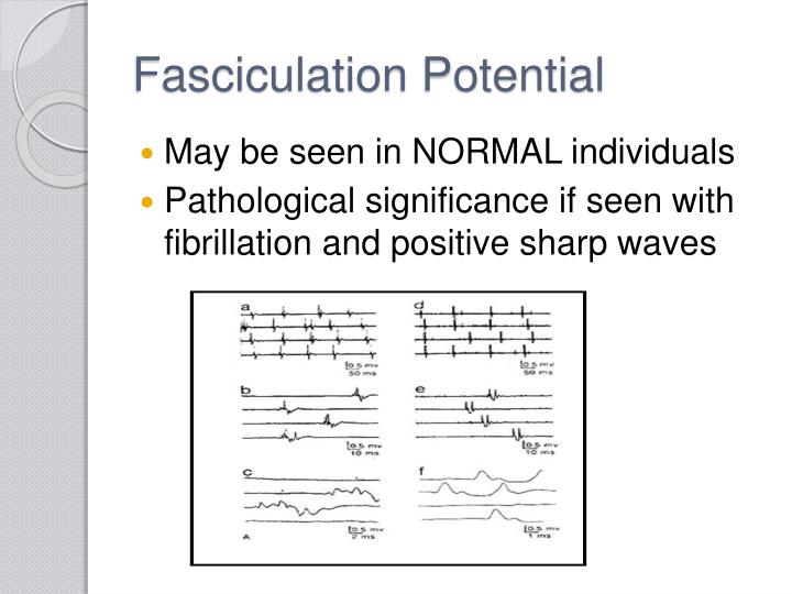 PPT - Electromyography (EMG) PowerPoint Presentation - ID:2098137