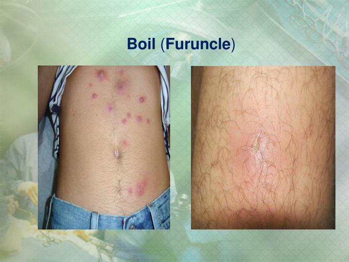 PPT - Surgical Infection PowerPoint Presentation - ID:2098299