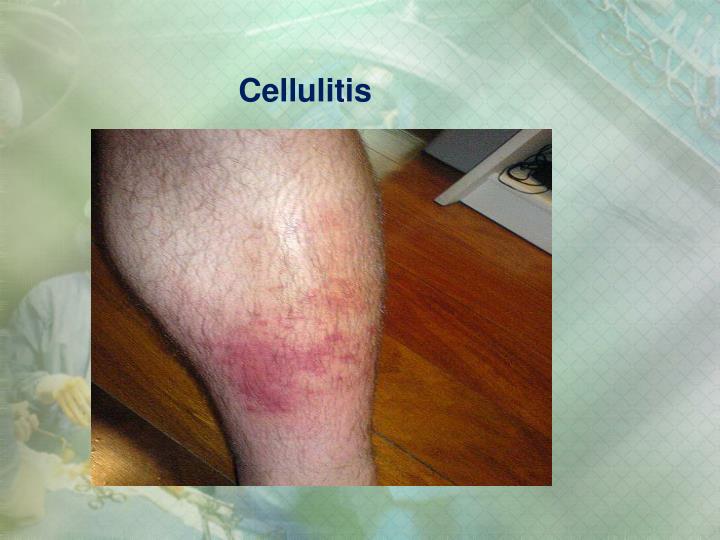 PPT - Surgical Infection PowerPoint Presentation - ID:2098299