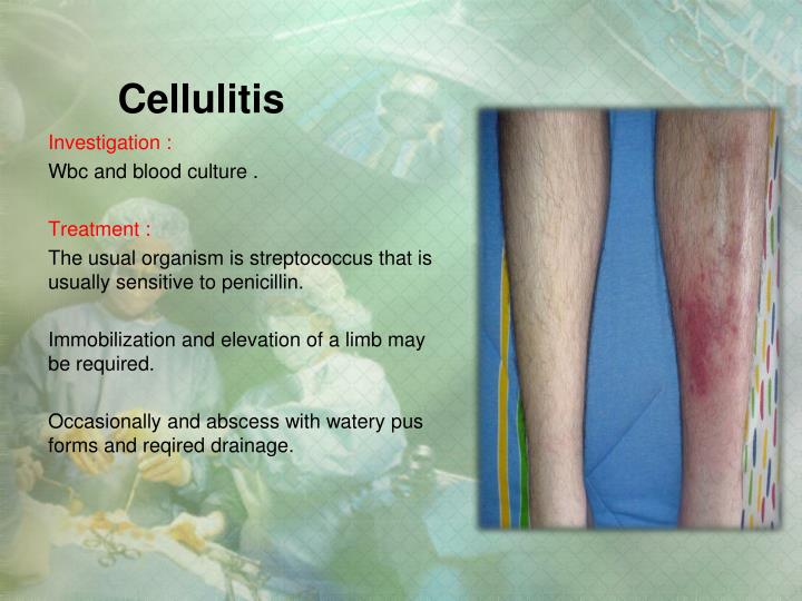 PPT - Surgical Infection PowerPoint Presentation - ID:2098299