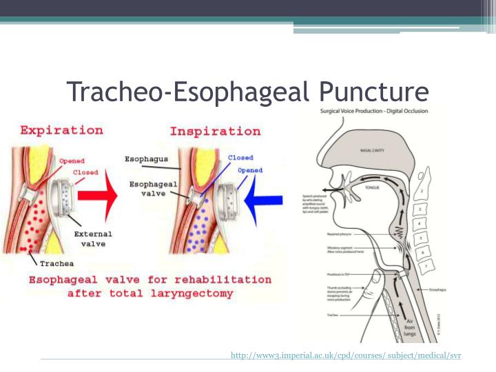 PPT - Laryngeal Cancer PowerPoint Presentation - ID:2098953