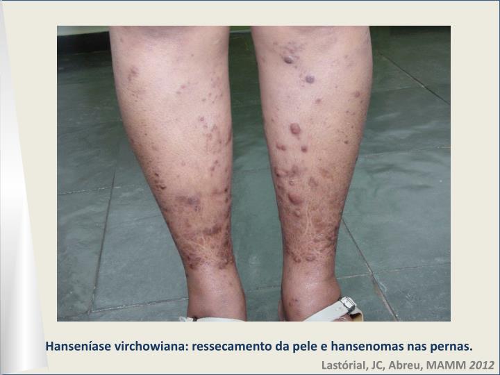 PPT - HANSENÍASE DIAGNÓSTICO PowerPoint Presentation - ID:2099902