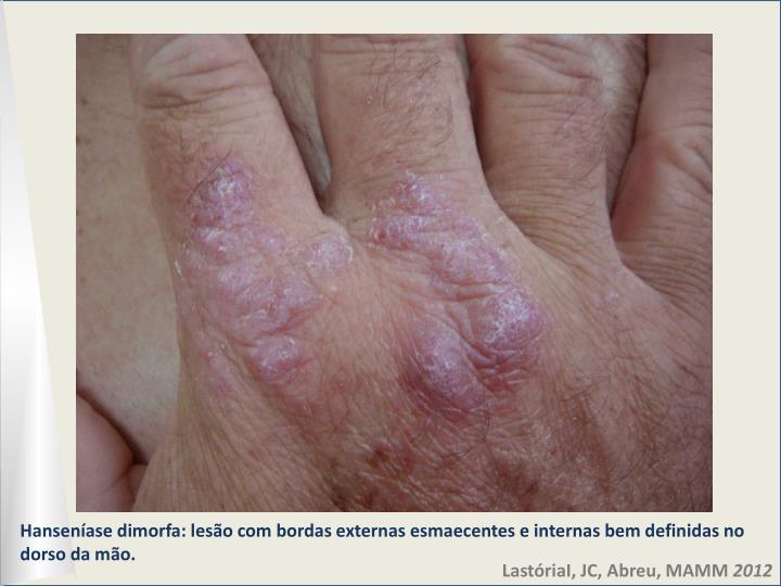 PPT - HANSENÍASE DIAGNÓSTICO PowerPoint Presentation - ID:2099902