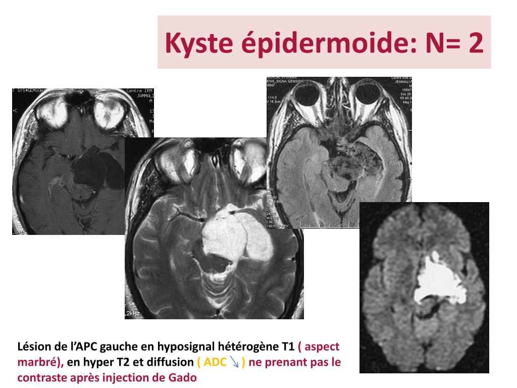 Kyste Épidermoïde Effets Secondaires – UPFV