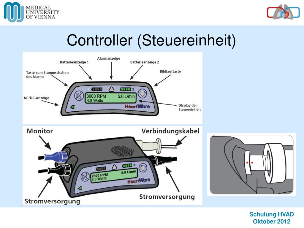 PPT - Left Ventricular Assist Device (LVAD) HeartWare HVAD T ...