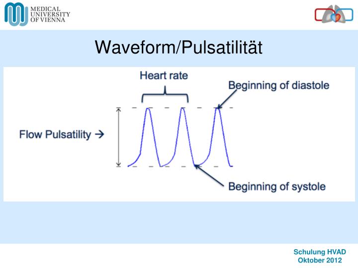PPT - Left Ventricular Assist Device (LVAD) HeartWare HVAD T ...