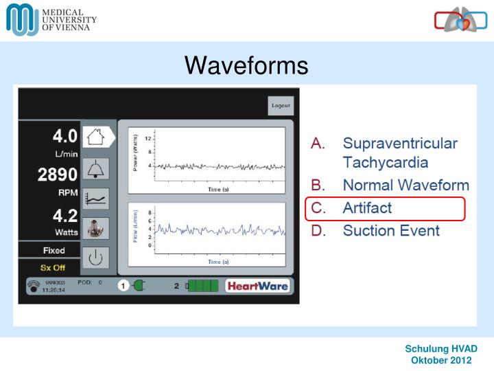PPT - Left Ventricular Assist Device (LVAD) HeartWare HVAD T ...