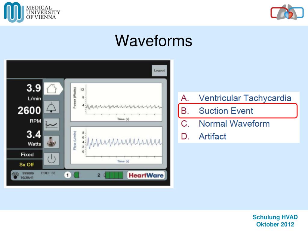PPT - Left Ventricular Assist Device (LVAD) HeartWare HVAD T ...