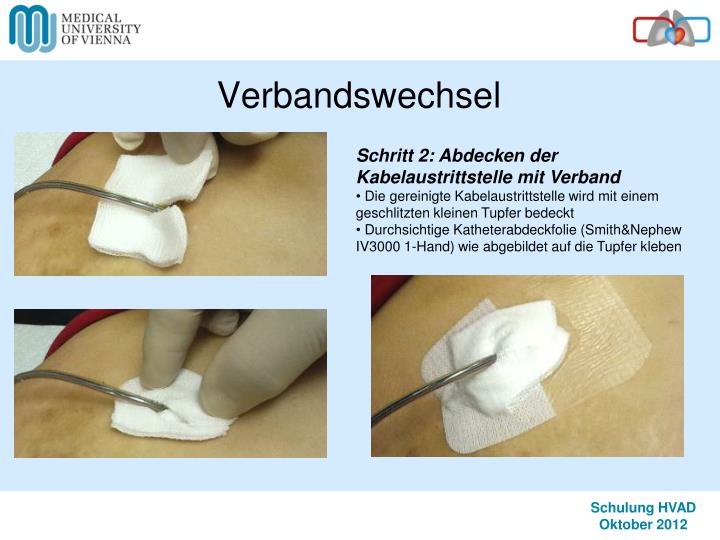 PPT - Left Ventricular Assist Device (LVAD) HeartWare HVAD T ...