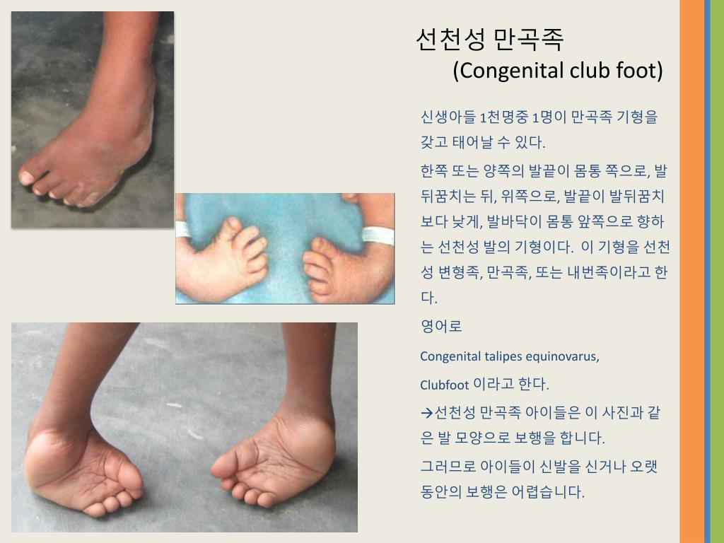 PPT - Congenital Clubfoot Children PowerPoint Presentation, free ...