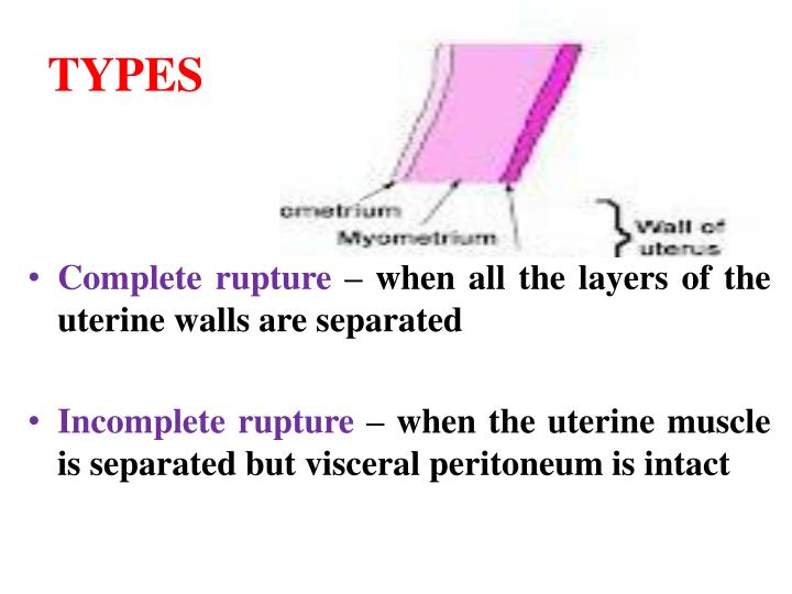 PPT - PLANNED TEACHING PROGRAMME ON PREVENTION OF UTERINE RUPTURE ...