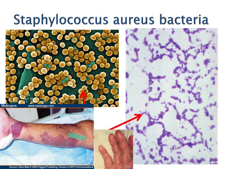 PPT - Toxic Shock Syndrome PowerPoint Presentation - ID:2105958