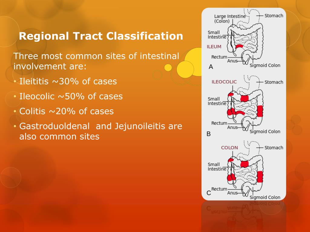 PPT - Crohn’s Disease aka regional enteritis PowerPoint Presentation ...