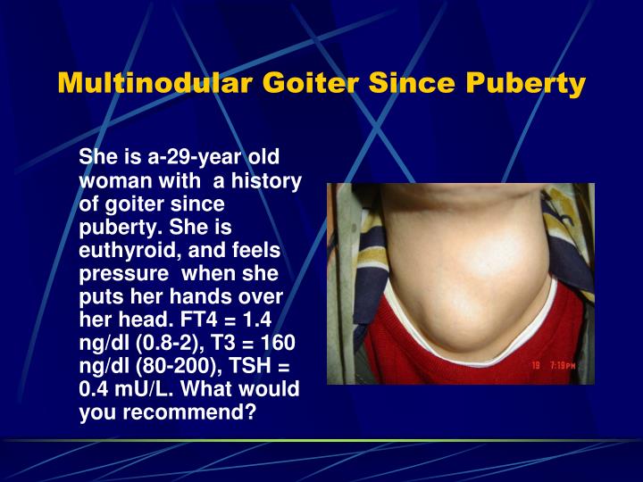 Nontoxic Multinodular Goiter