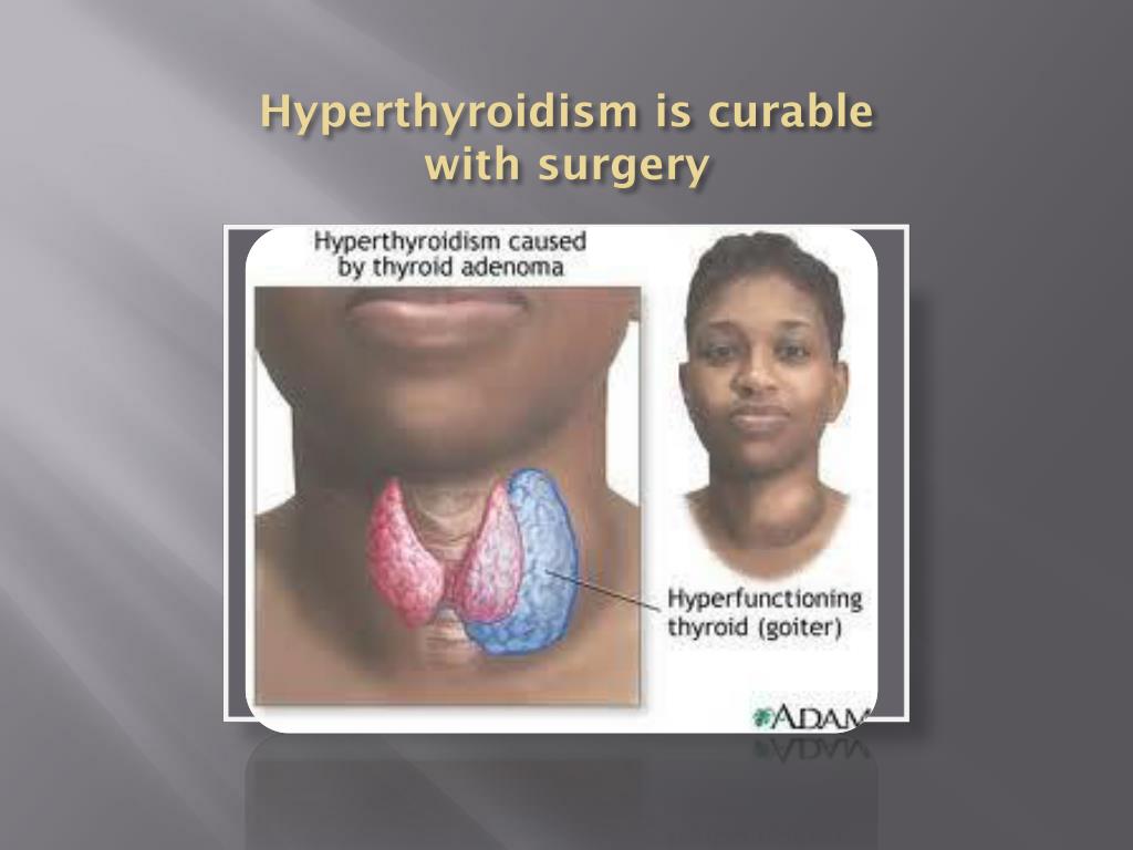 PPT - Endocrine system disease. Hyperthyroidism leticia pelagio ...
