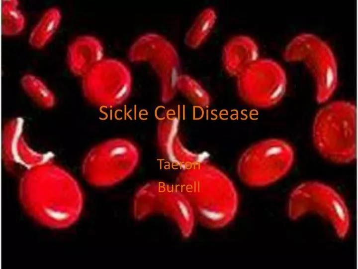 PPT - Sickle Cell Disease PowerPoint Presentation - ID:2110033